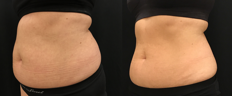 Evolve X- The Complete Body Contouring Treatment