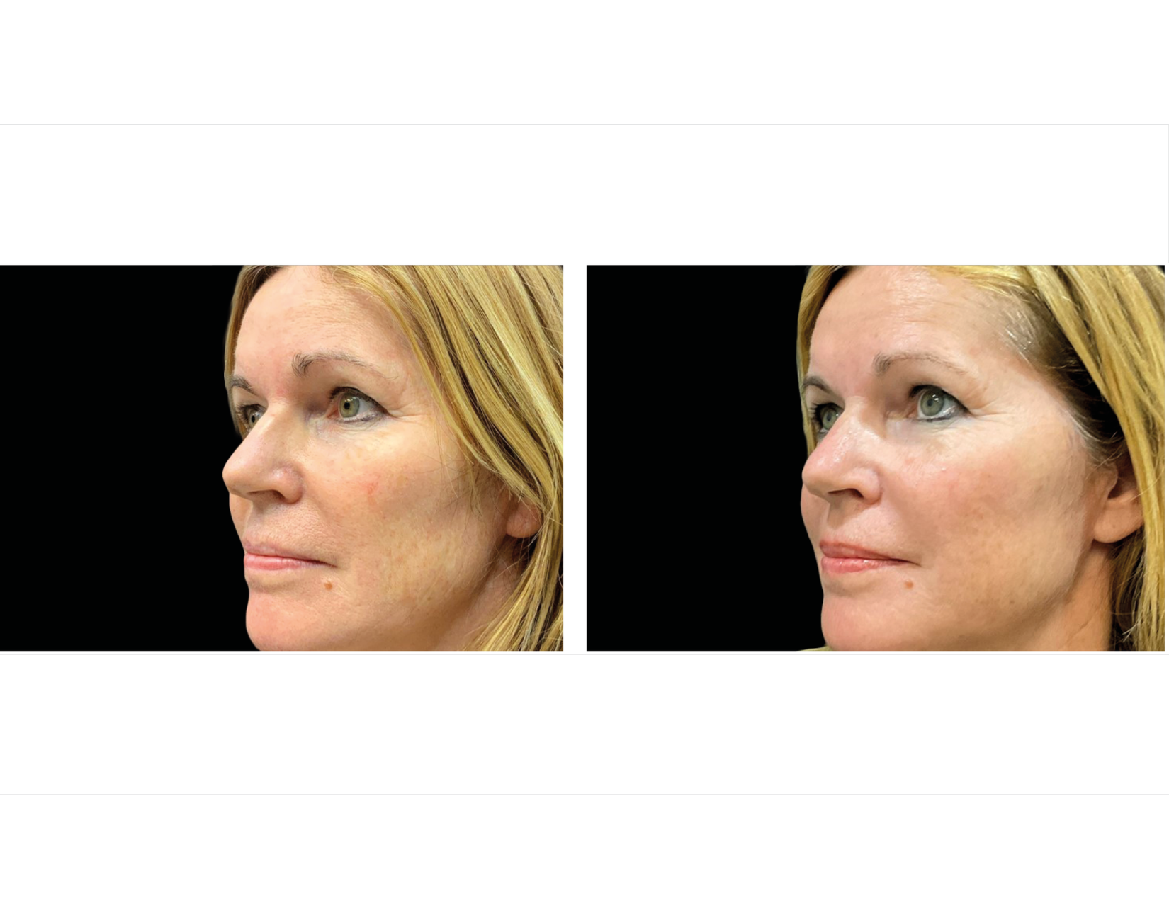 EXION Face Los Angeles: Non-Invasive Rejuvenation